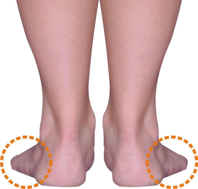 QUADRASTEP® Foot Orthotics - E Quad - Freed Foot